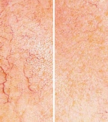 Laser vasculaire | Médecine Esthétique Châtelet Paris